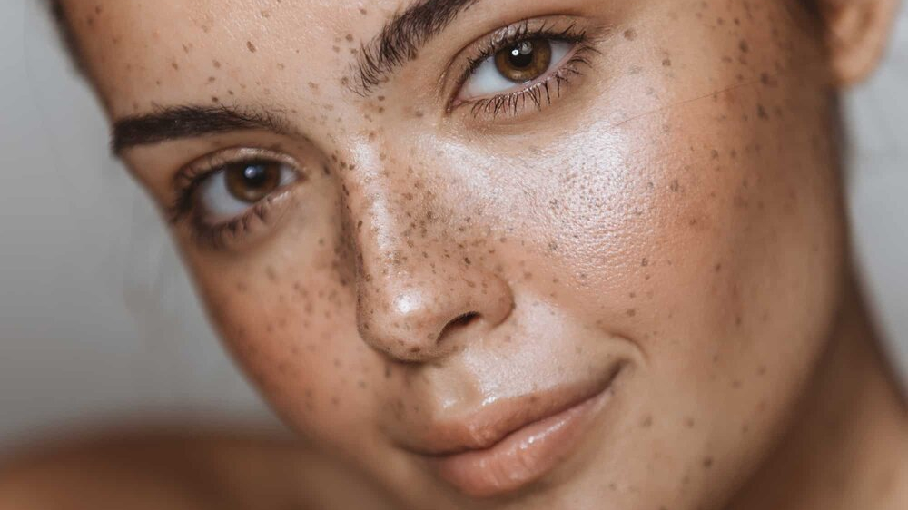 Hyperpigmentation Can Get Worse in Dry Weather – General Health Magazine