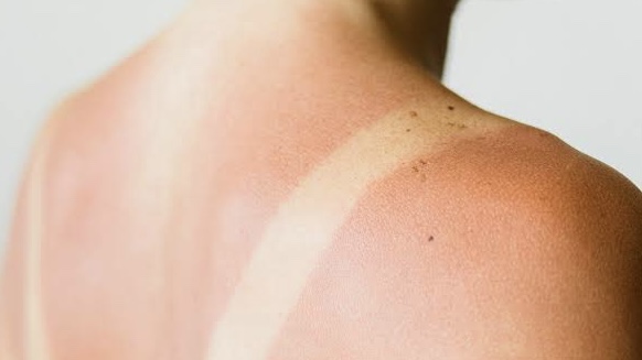 Natural Sunburn Remedies for a Fast Recovery – General Health Magazine